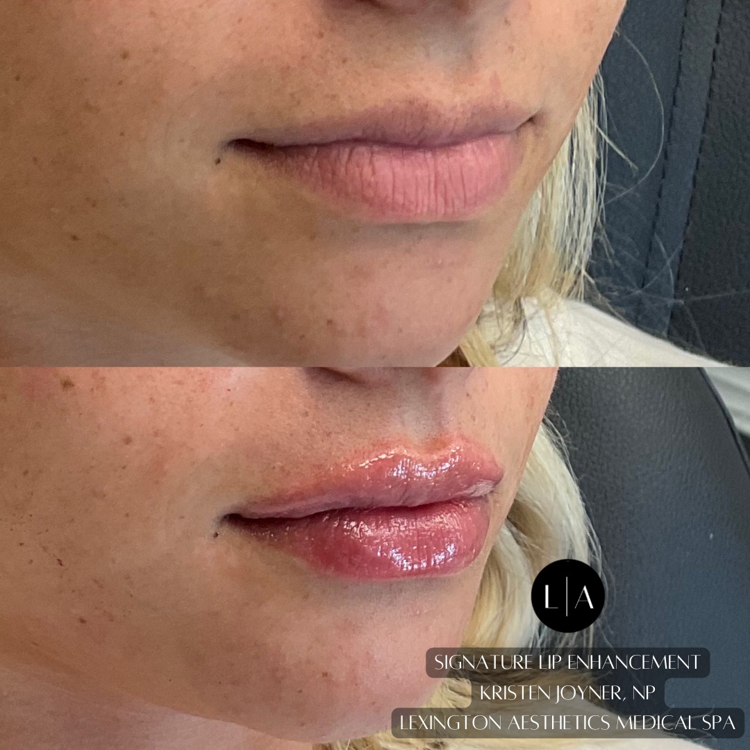 Before And After - Lexington Aesthetics Medical Spa