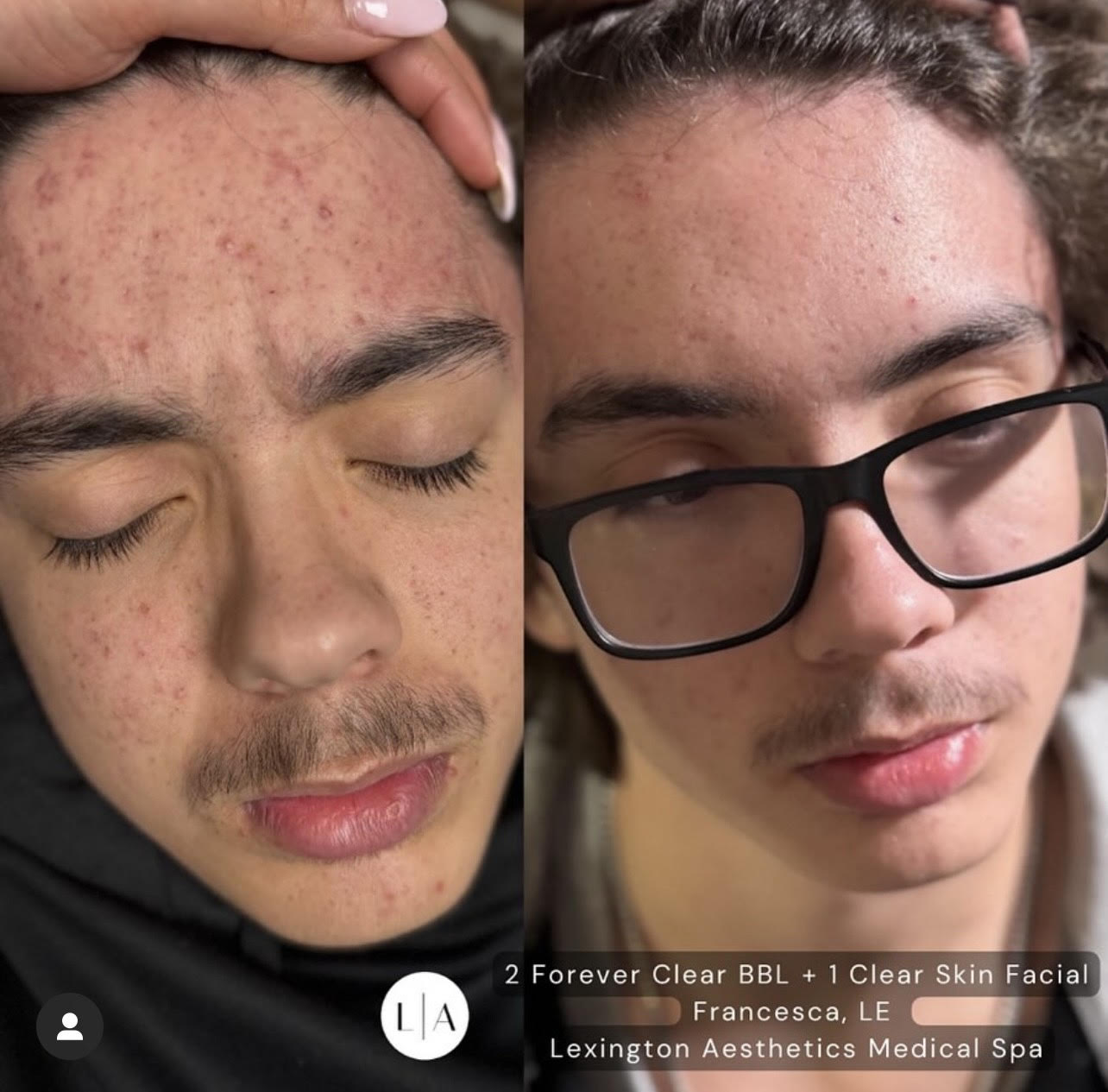 Before And After - Lexington Aesthetics Medical Spa