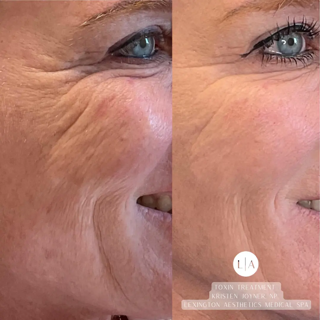 Before And After - Lexington Aesthetics Medical Spa