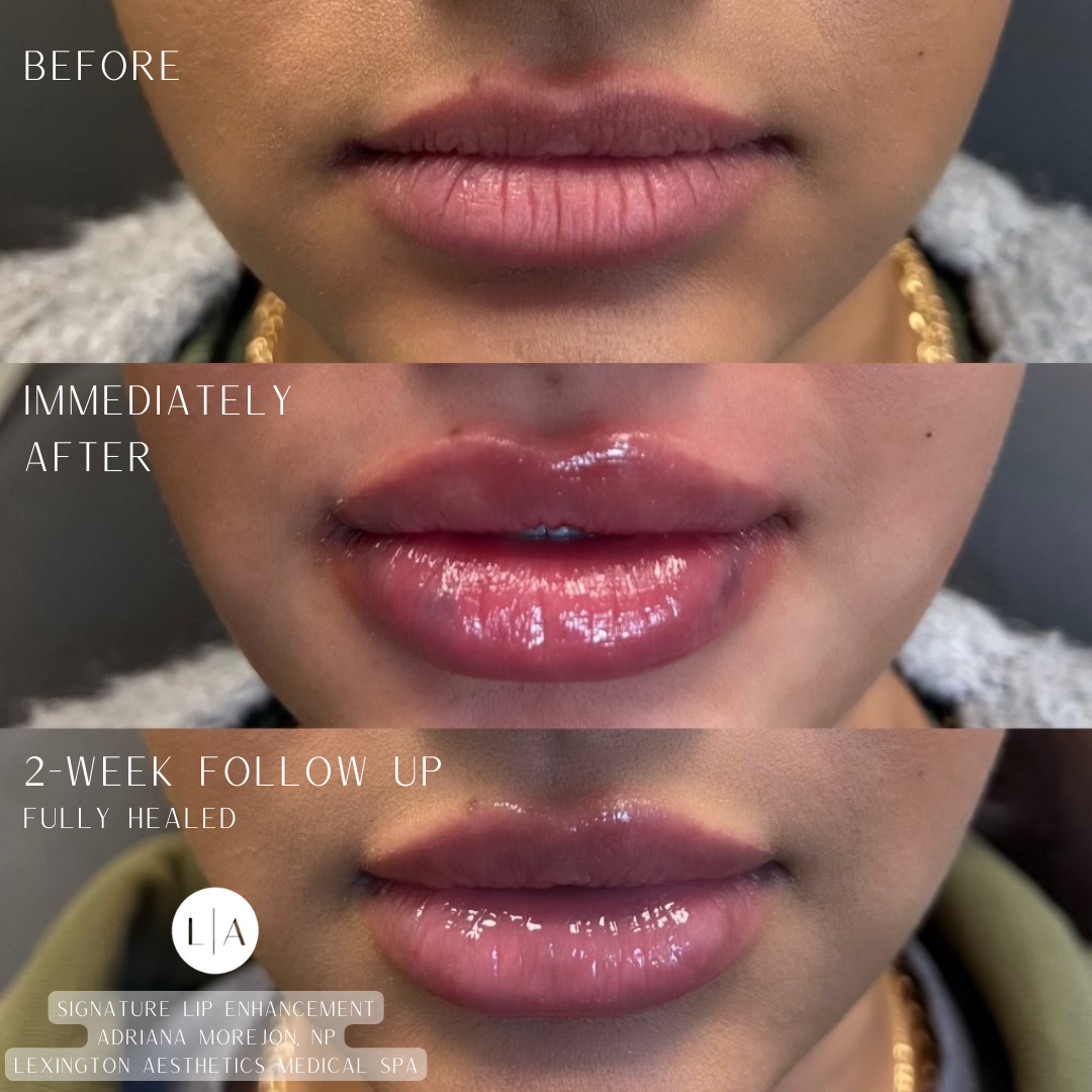 Before And After - Lexington Aesthetics Medical Spa