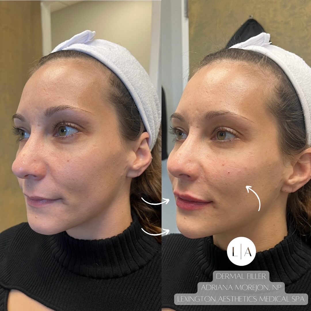Before And After - Lexington Aesthetics Medical Spa