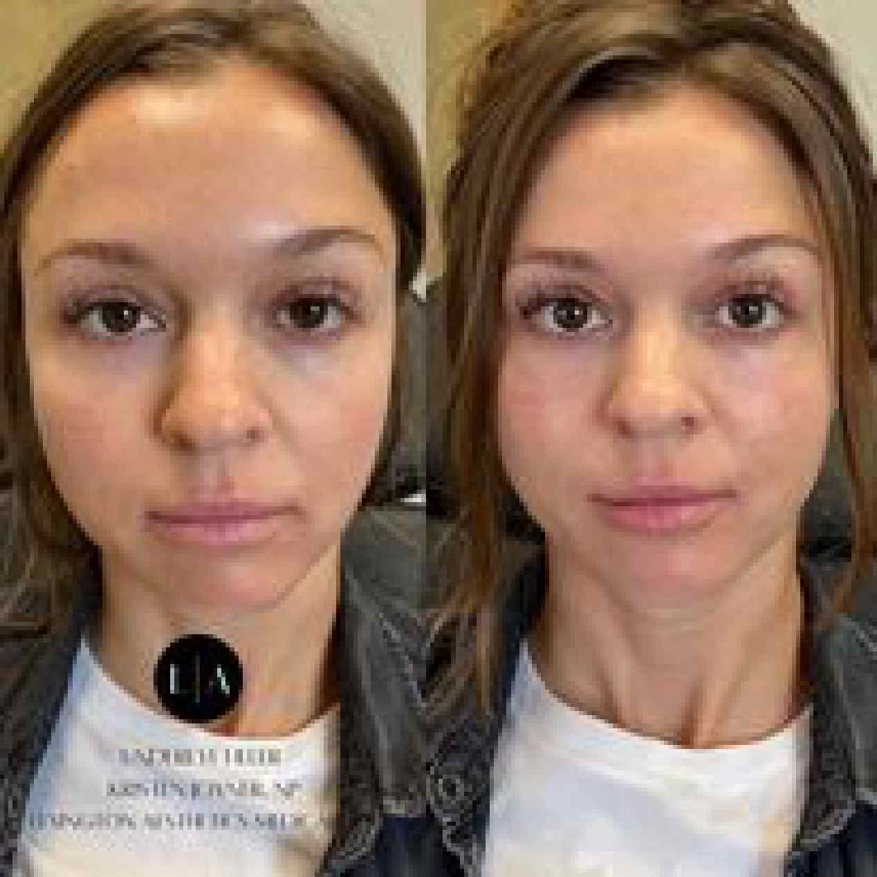 Before And After - Lexington Aesthetics Medical Spa
