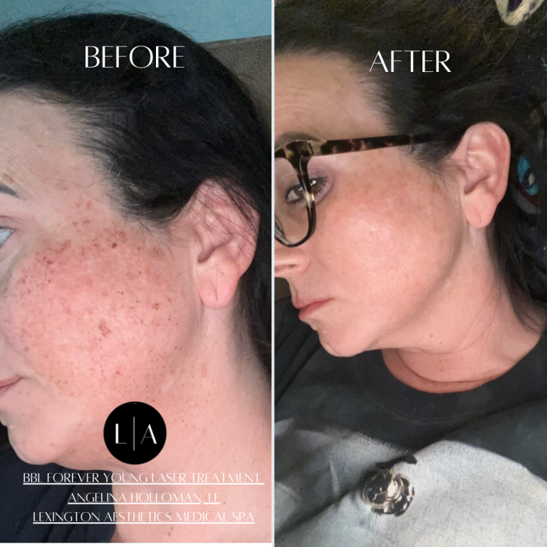 Before And After - Lexington Aesthetics Medical Spa