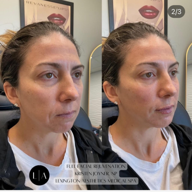 Before And After - Lexington Aesthetics Medical Spa